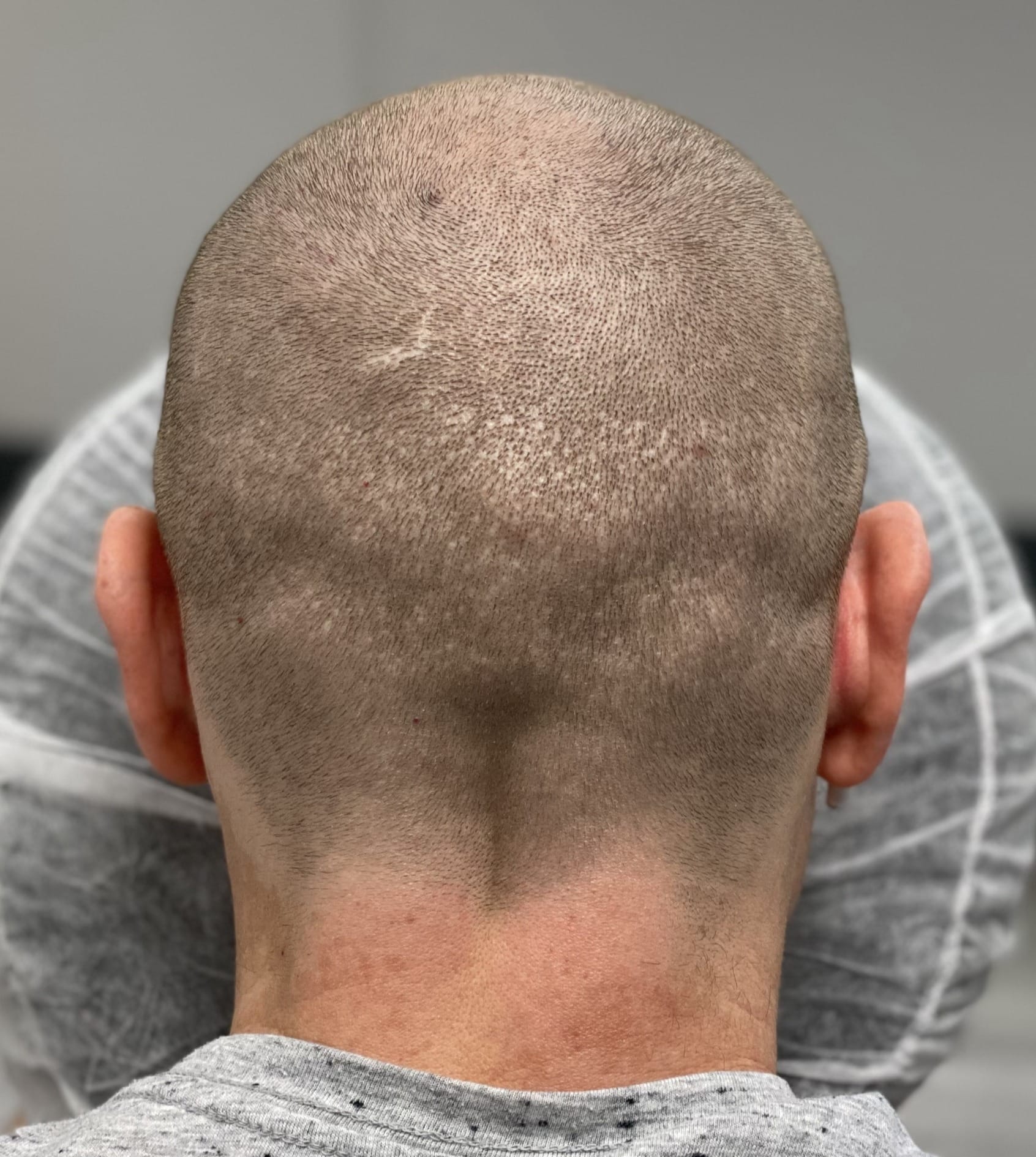 SMP for Scar Camouflage Bethesda | Natural Hairline Tattoo