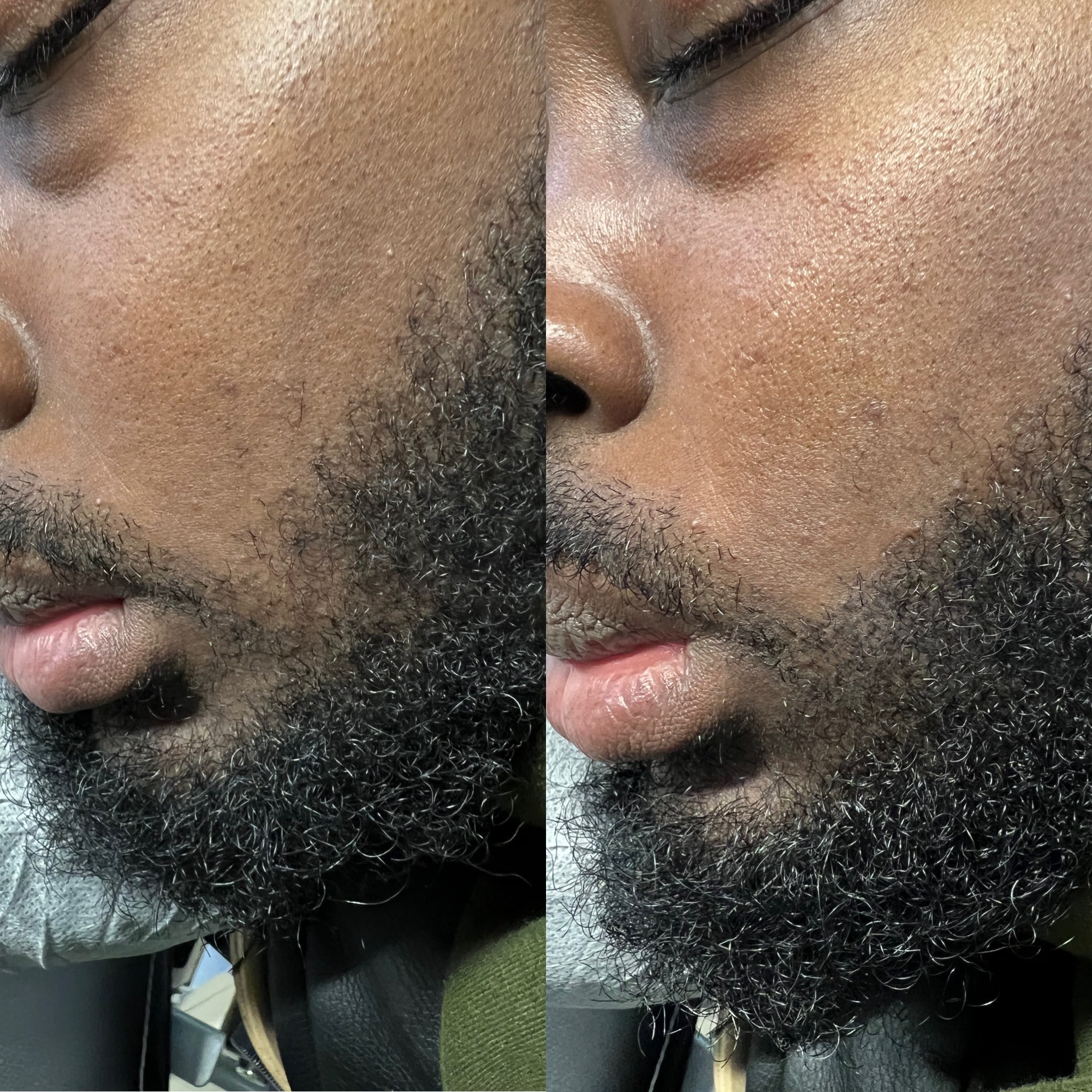 Scalp Micropigmentation for Patchy Beard | Full Facial Hair